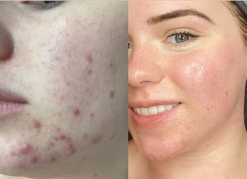 Trudermal Glow LED Light Therapy Face Mask