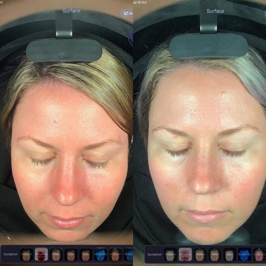 Trudermal Glow LED Light Therapy Face Mask